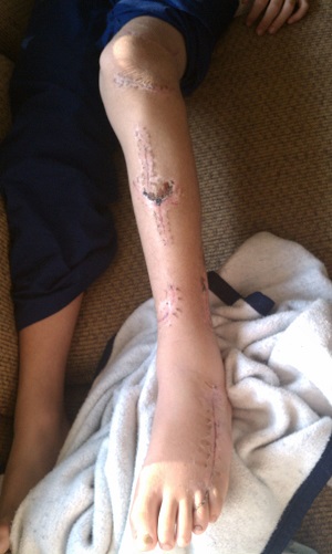 $1.3 Million for Boating Accident Victim with Serious Leg Injuries
